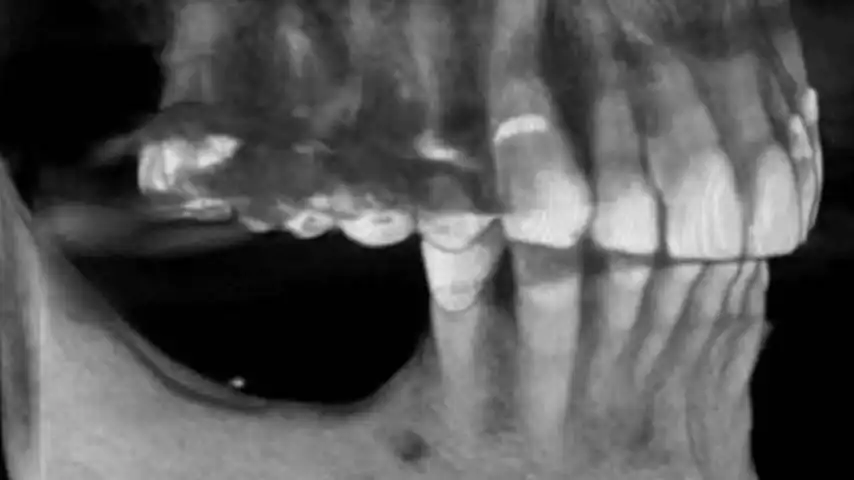 Vertical ridge augmentation of the atrophic posterior mandible