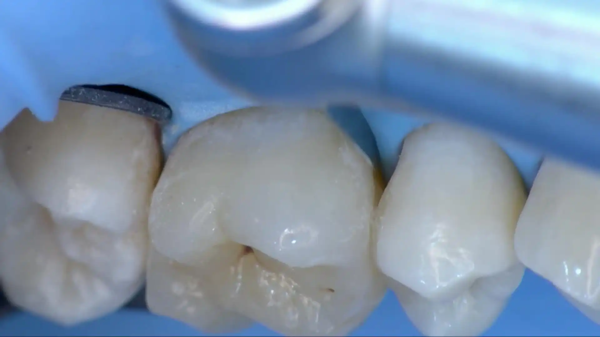 Composite Overlay Preparation and Cementation