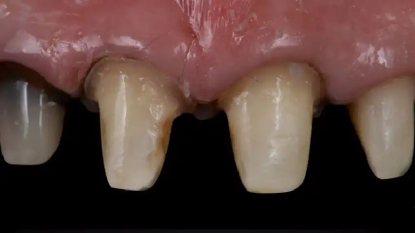 Coronas en dientes naturales: indicaciones y protocolos