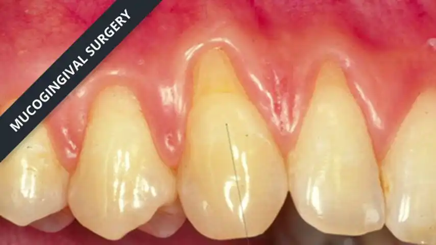 Coronally advanced flap for multiple gingival recessions