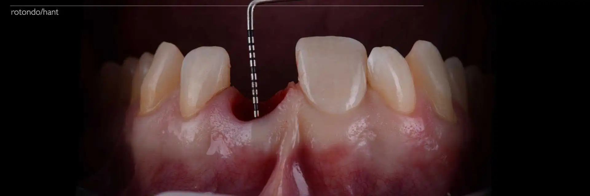 醴 Implantology – Dental Video Courses by osteocom