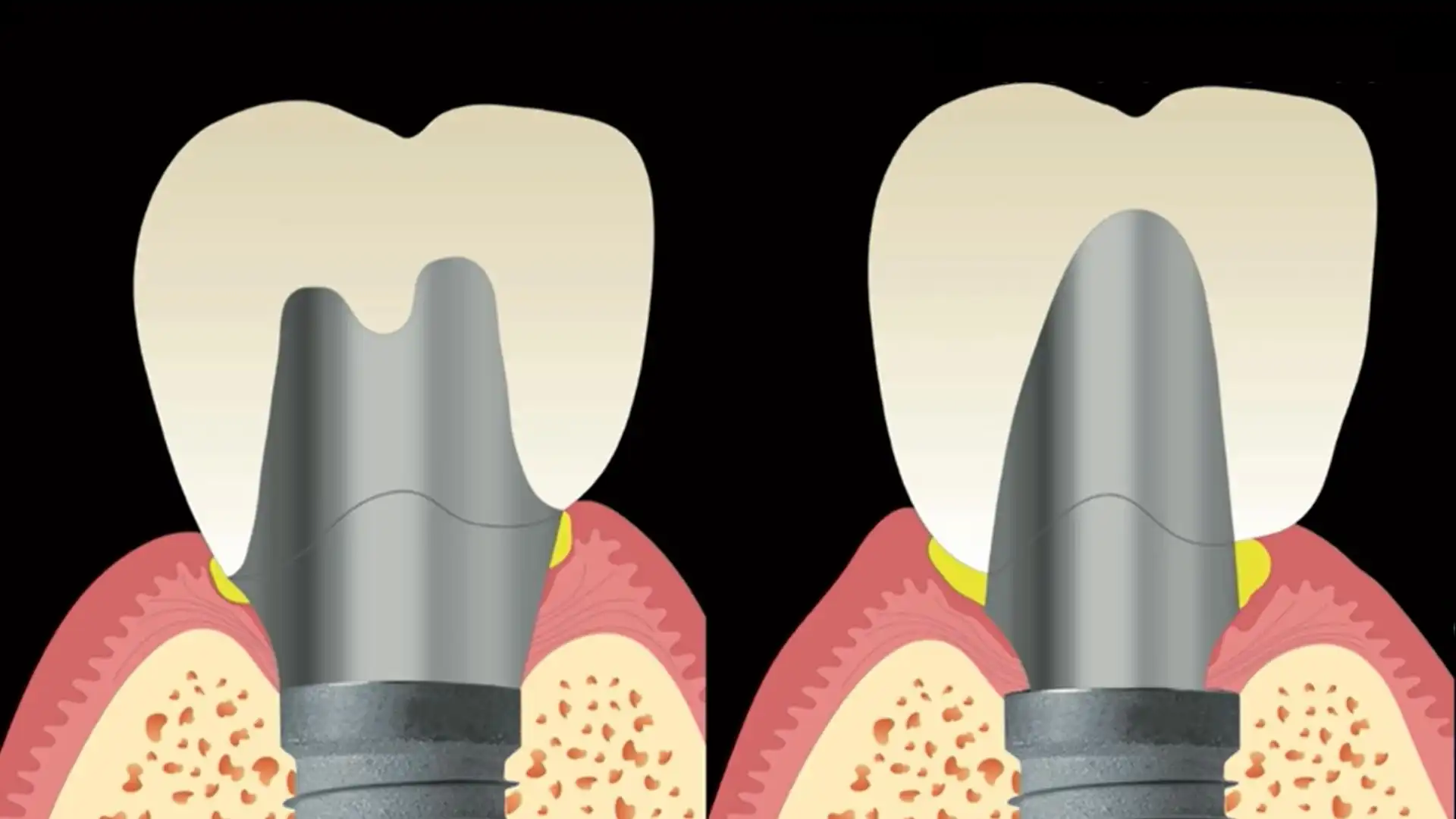 Prosthetic aspects to enhance the stability of hard and soft peri ...