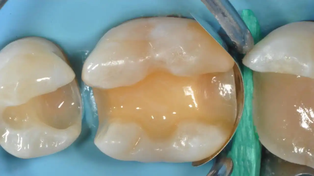 Posterior matrices: choice and use