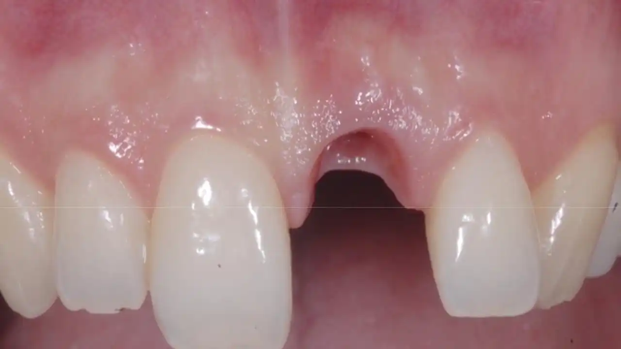 Soft tissue approach to delayed post-extraction implant installation