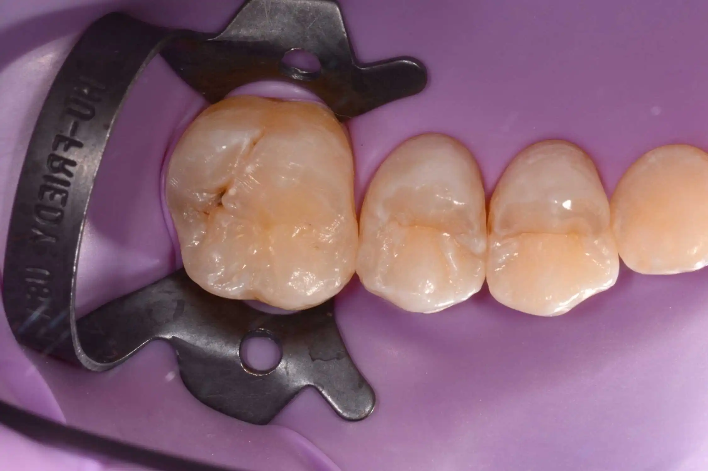 Rubber Dam Isolation Techniques