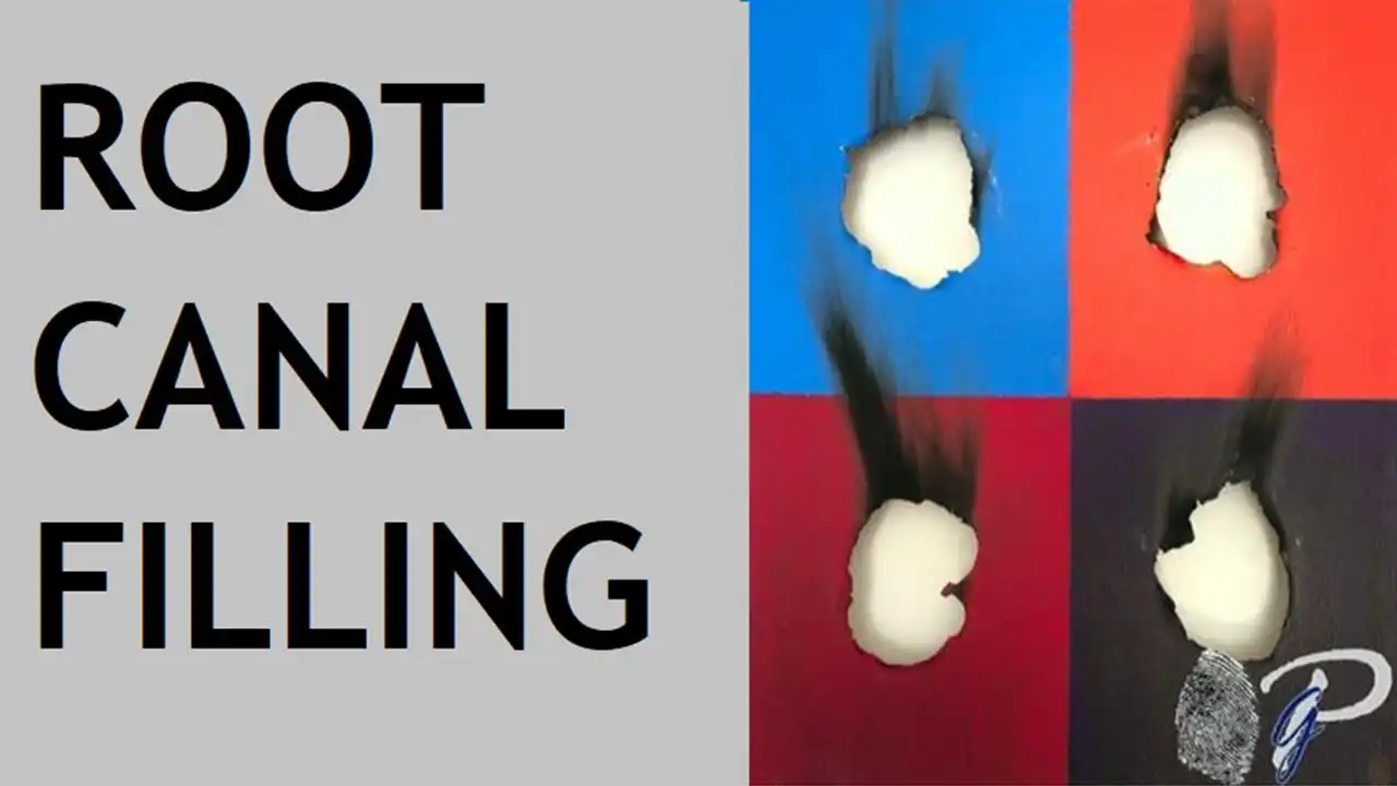 Filling root canals in 3-Dimensions