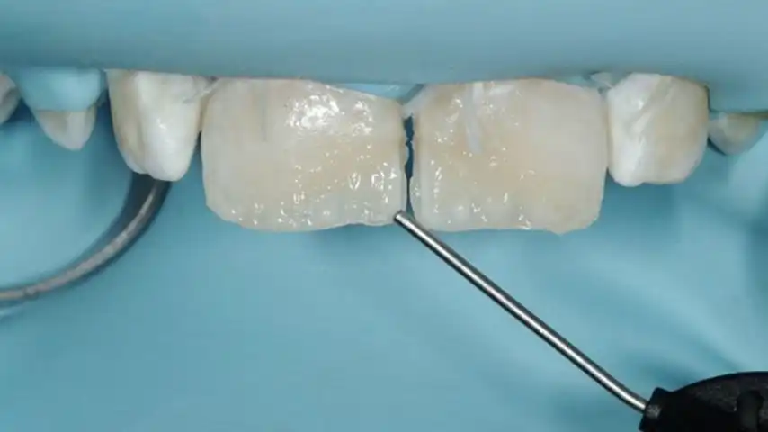 Indications & Limits of Direct Bonding in Anterior Esthetics - Module 1