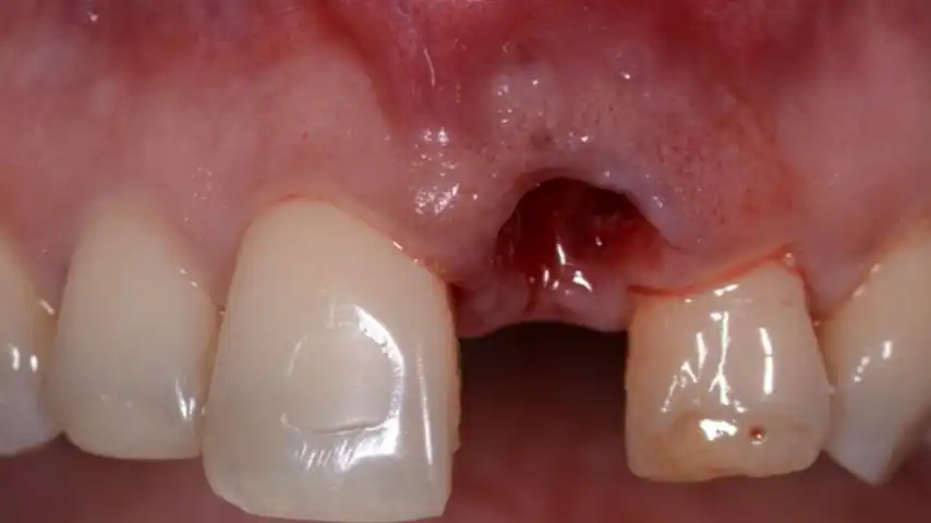 How to surgically manage post-extraction implants with no vestibular ...