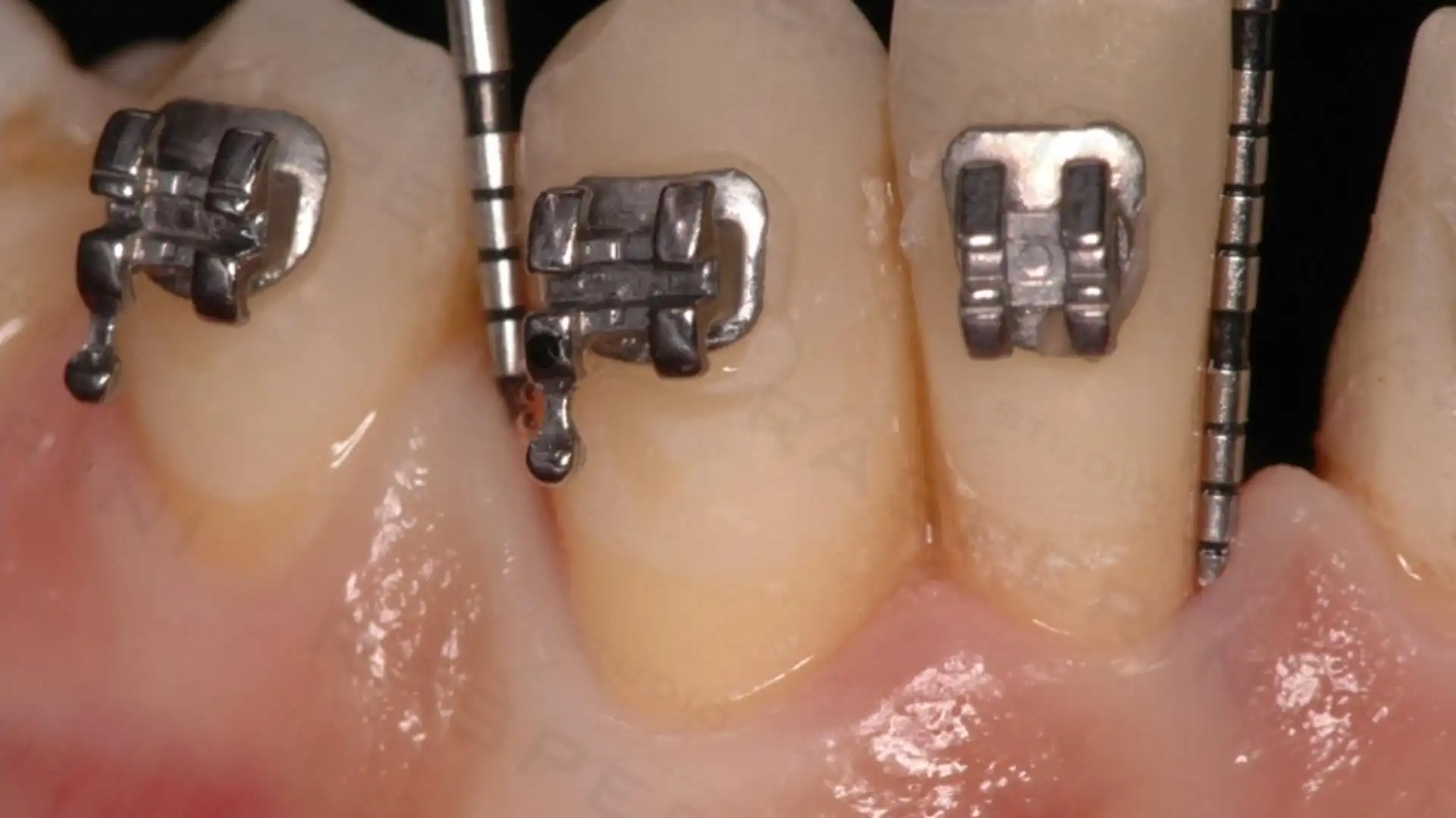 Ortho-perio, root resorption