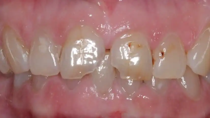 Understanding various terminologies of occlusion and making it clear