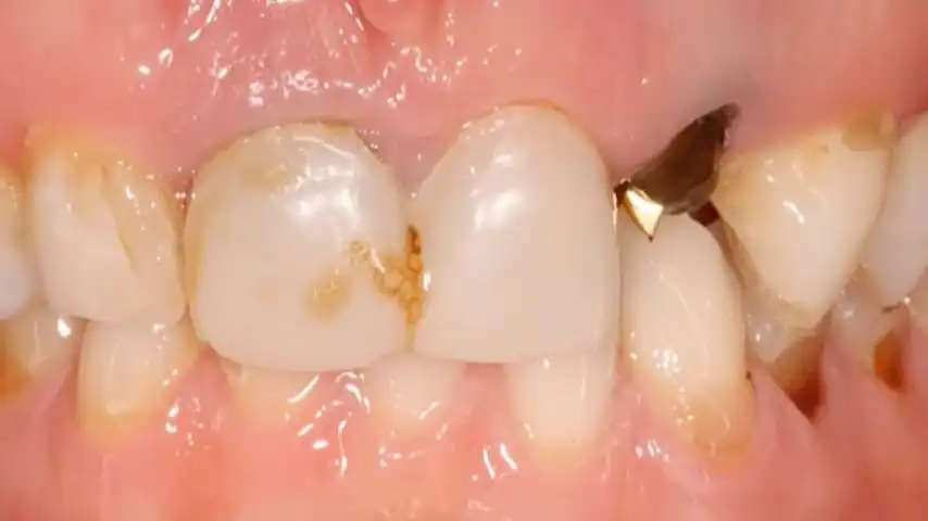 Application of occlusion in general dental practice