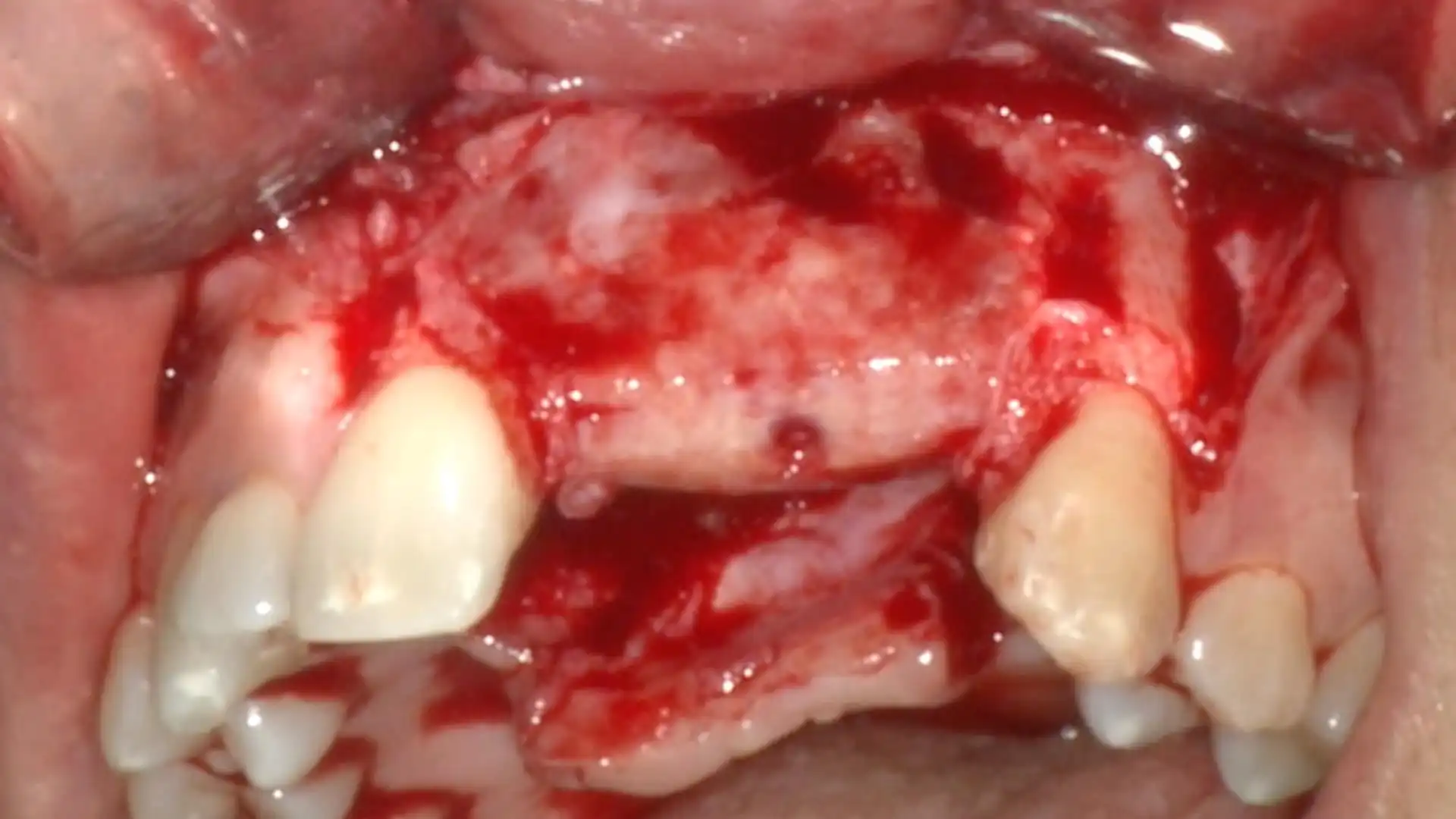 Vertical ridge augmentation: 7 months healing evaluation, implant ...