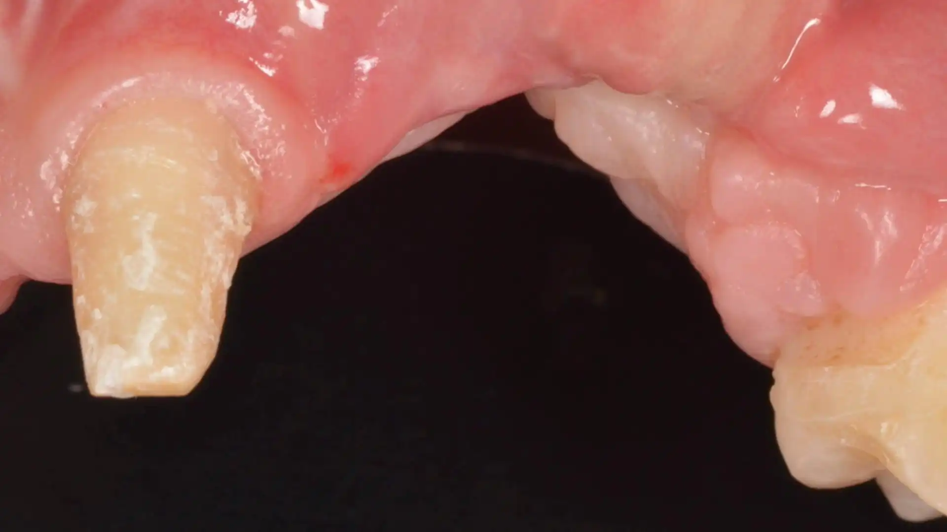 Complex case of regenerative dentistry with resorbable membrane