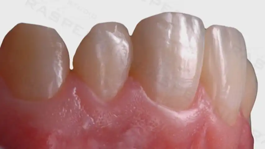 Phenotype assessment and mucogingival surgery concepts in modern ...