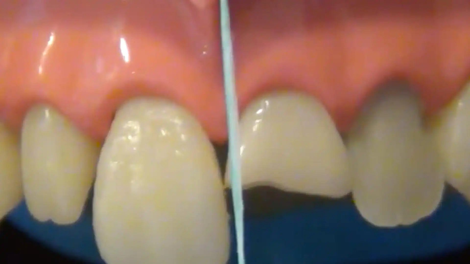 Class IV Tooth 21 - Video tutorial