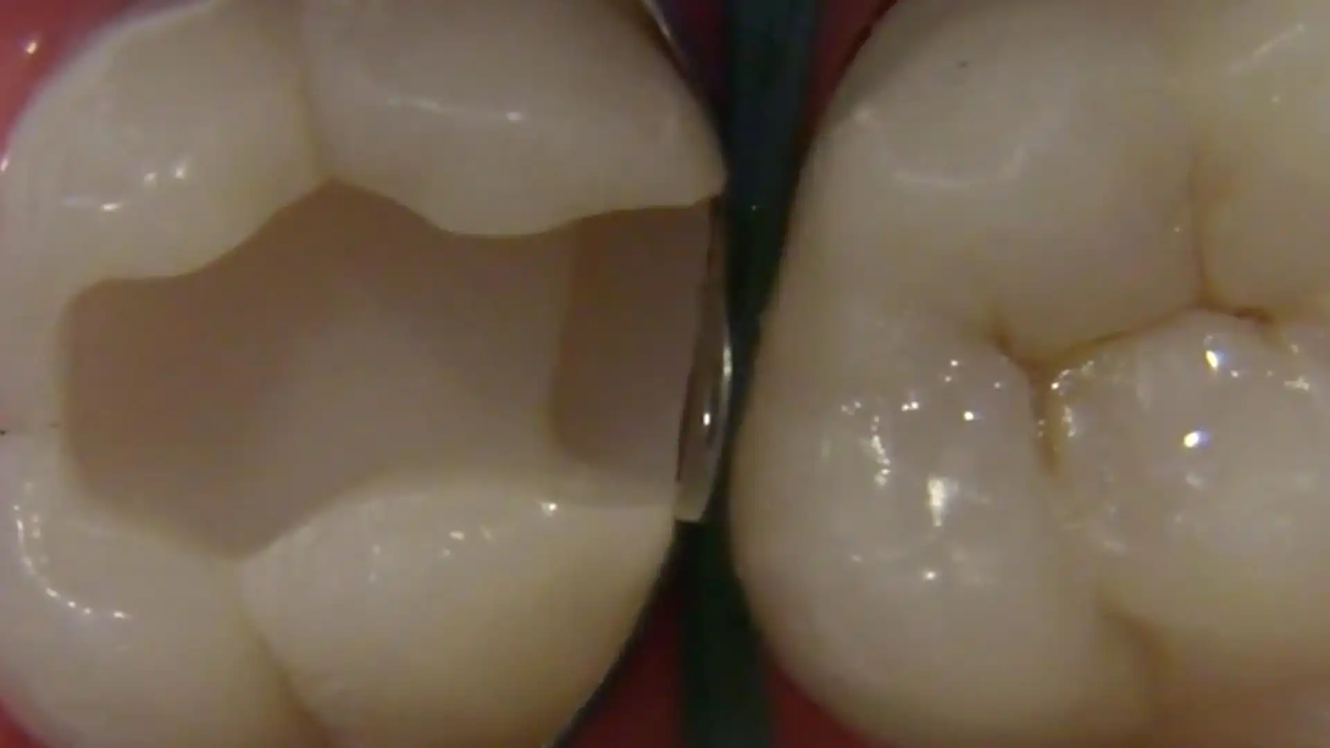Class II Tooth 17 - Video tutorial
