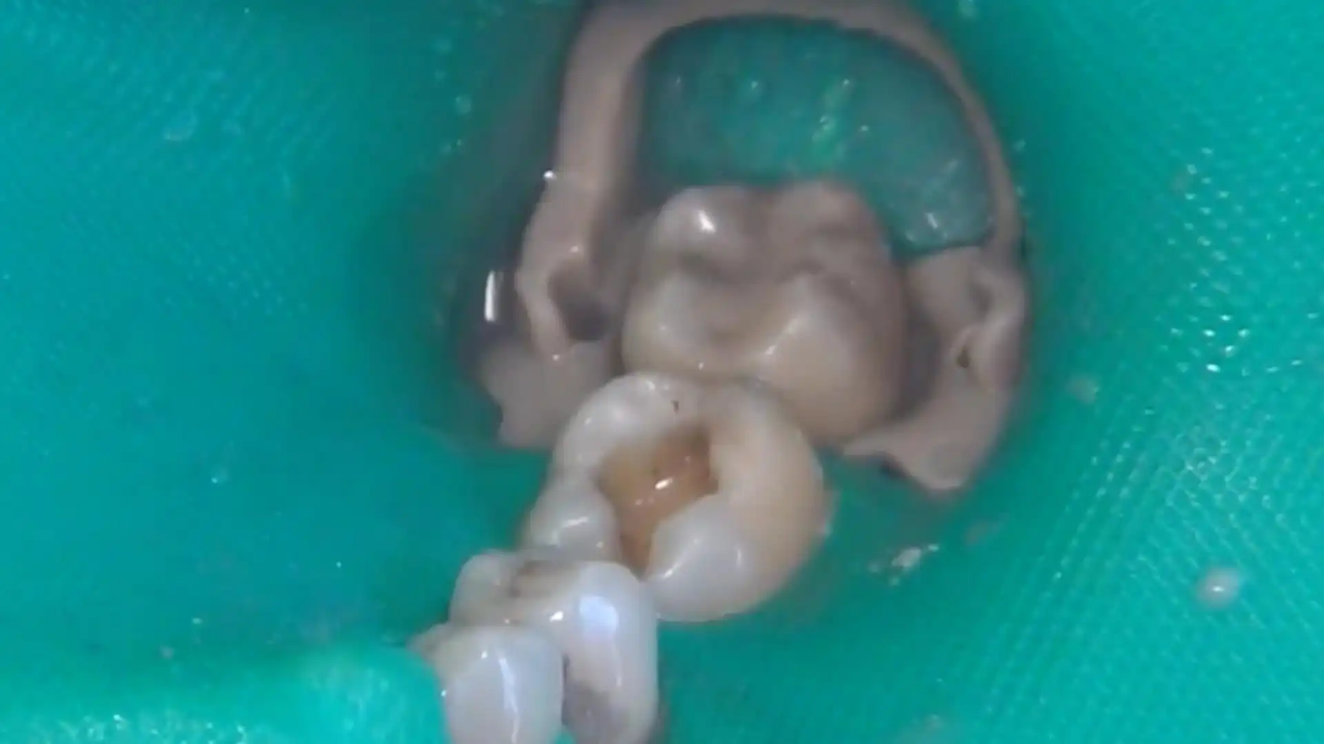 Class I Bulk Fill Flowable - Clinical Case