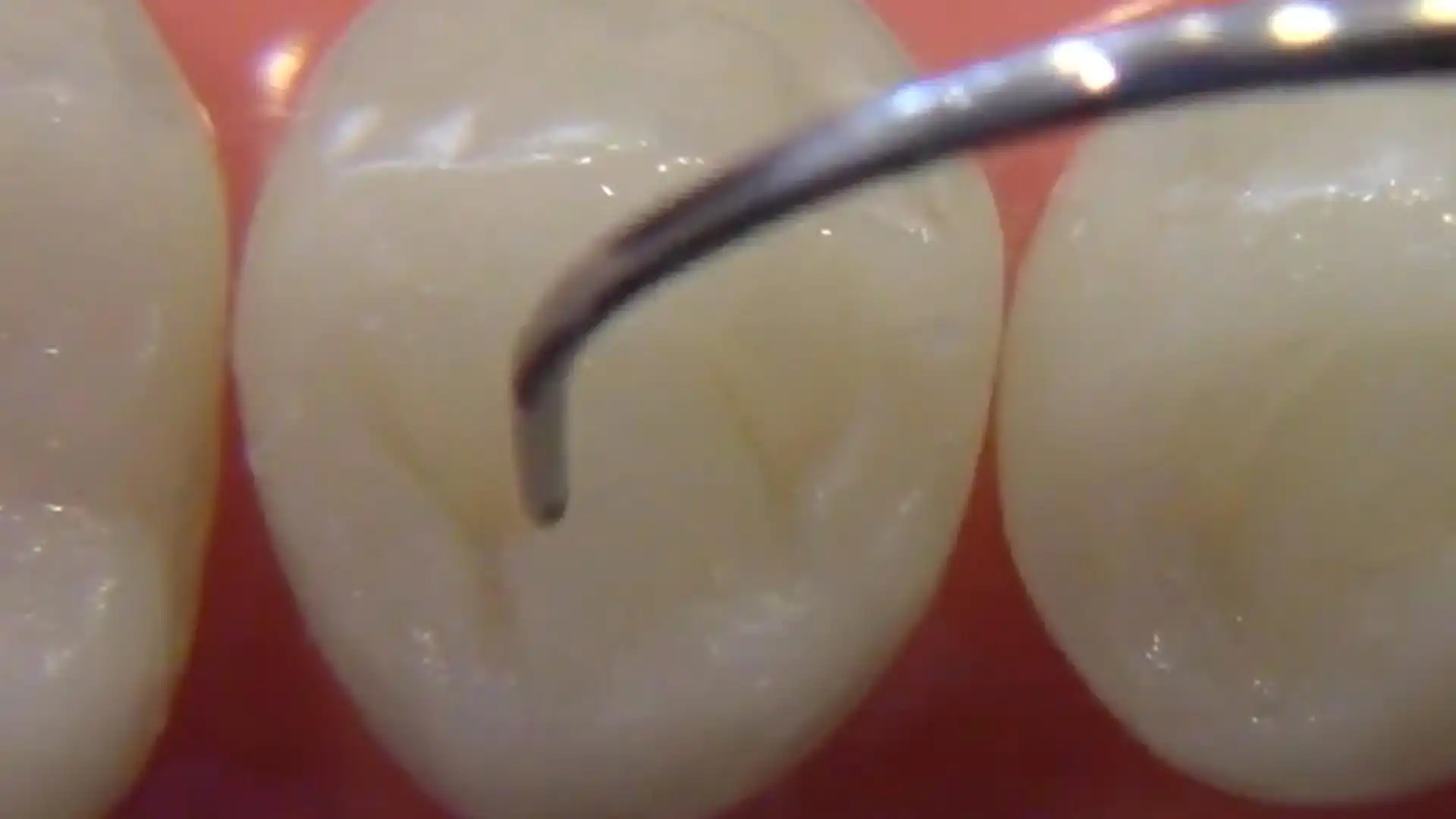 Class I using regular bulk-fill composite - Hands-On Class