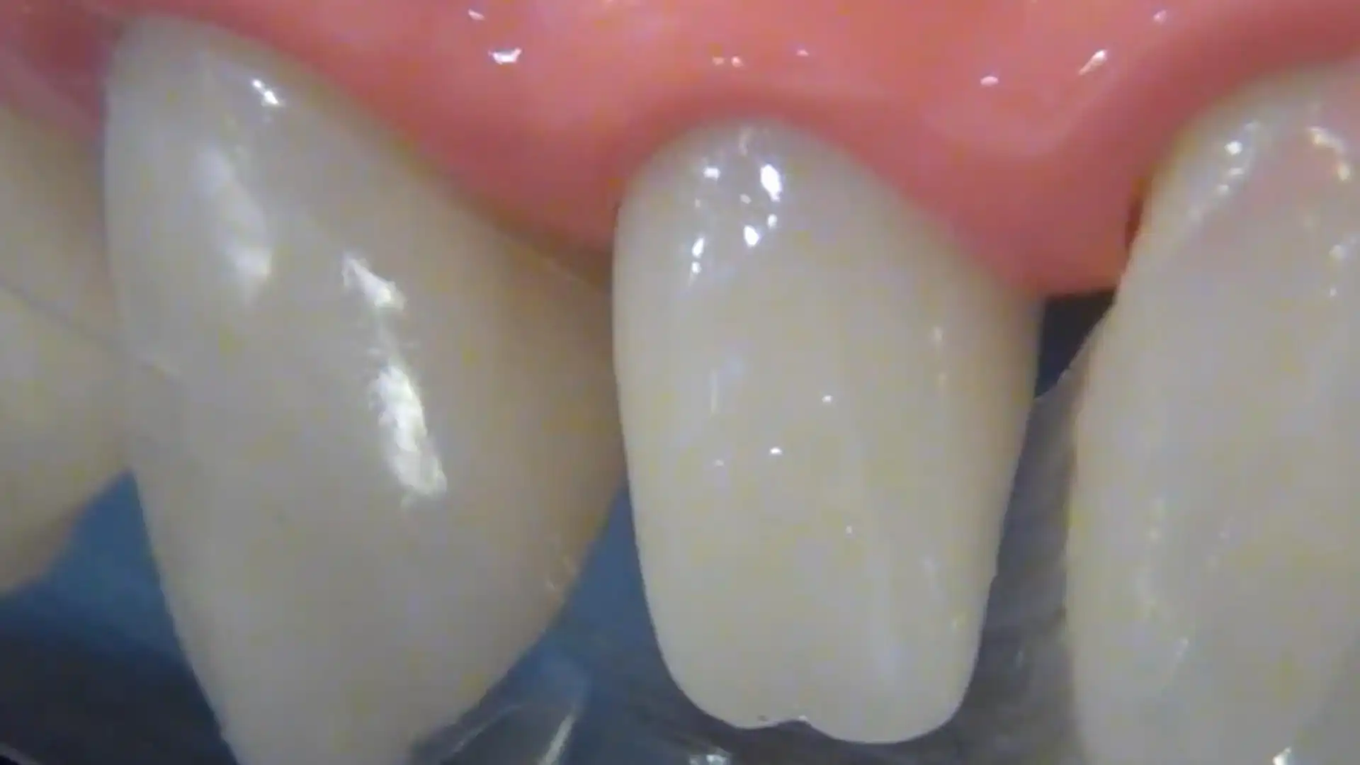 Peg lateral tooth 12 - Video tutorial