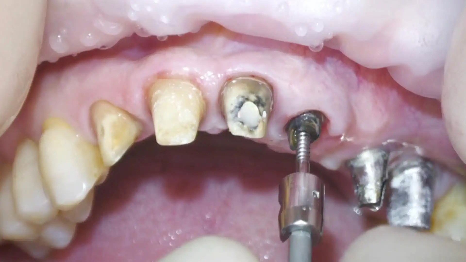 Immediate single tooth implant placement in the esthetic zone