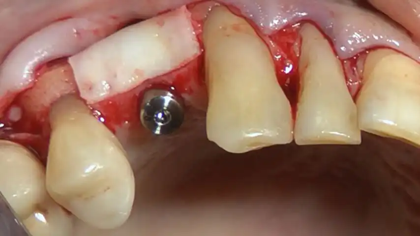 Implant placement on element 14 and contextual CTG with simultaneous ...