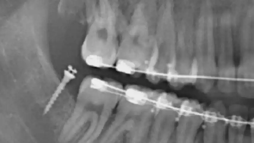 TADs extra-radicular insertion