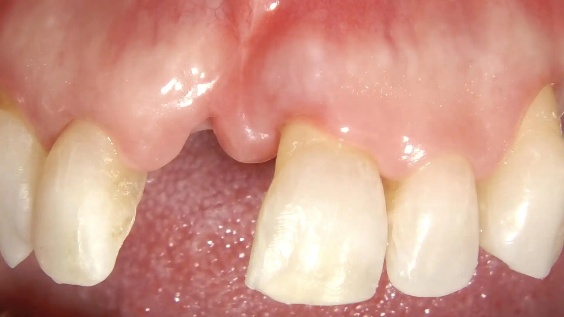 Soft tissue augmentation in zone 21