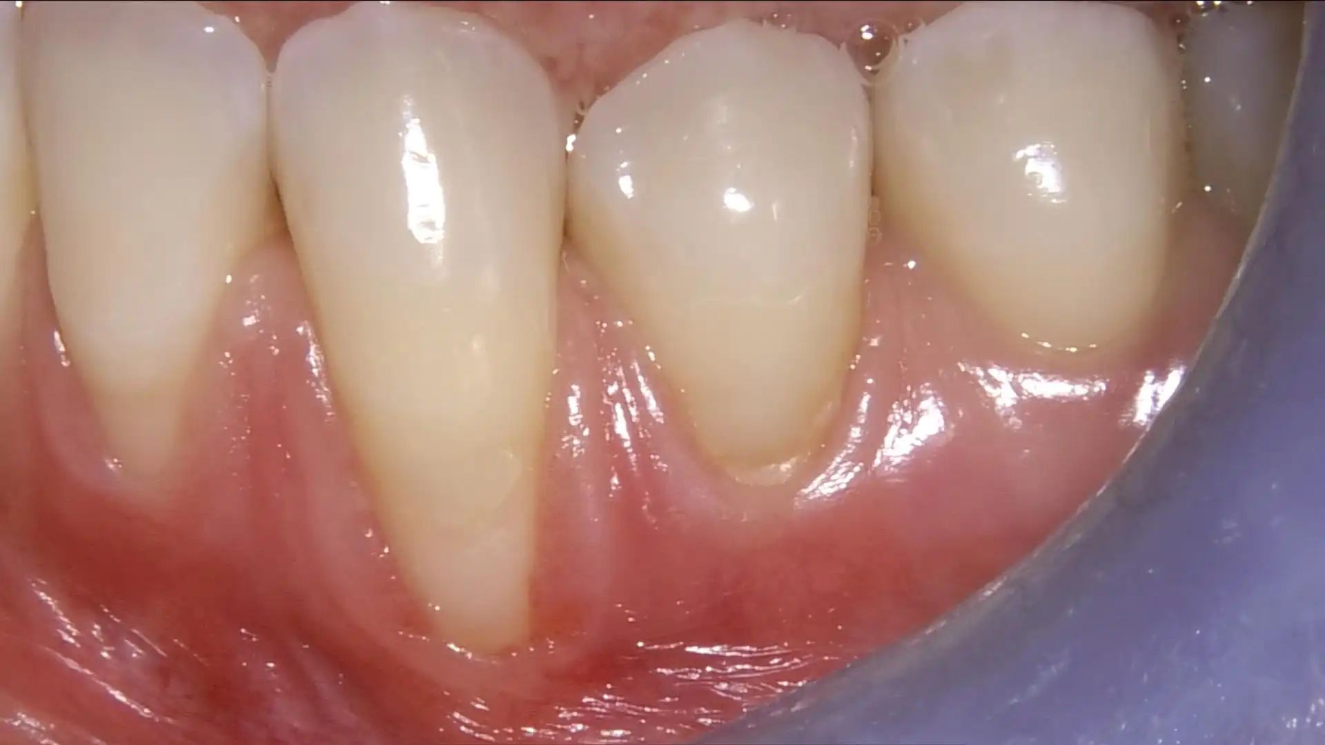 Coronally advanced flap and connective graft for the treatment of two ...