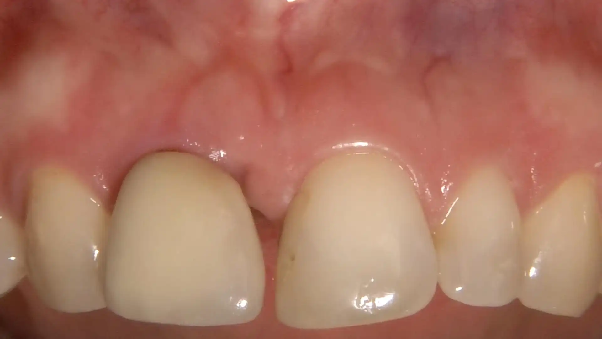 Post-extraction guided implant surgery in zone 11 with CTG graft