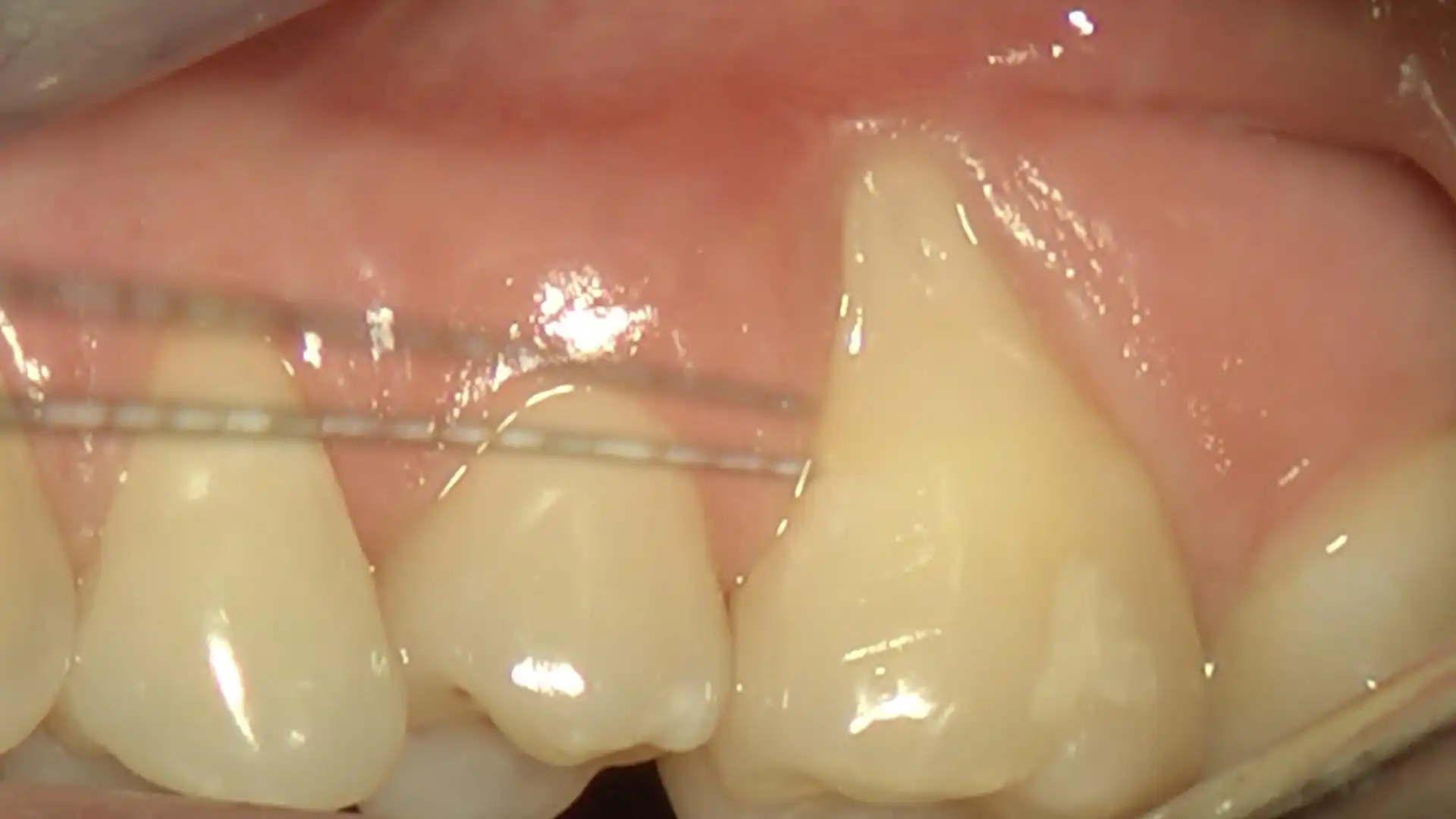 Coronally advanced flap and connective graft for gingival recession ...
