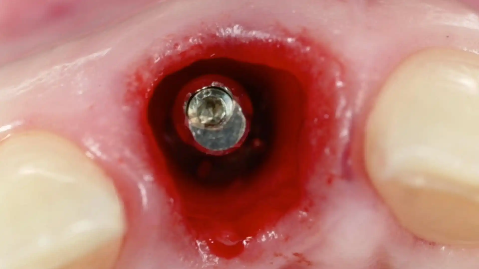 Immediate Loading single tooth: post-extraction