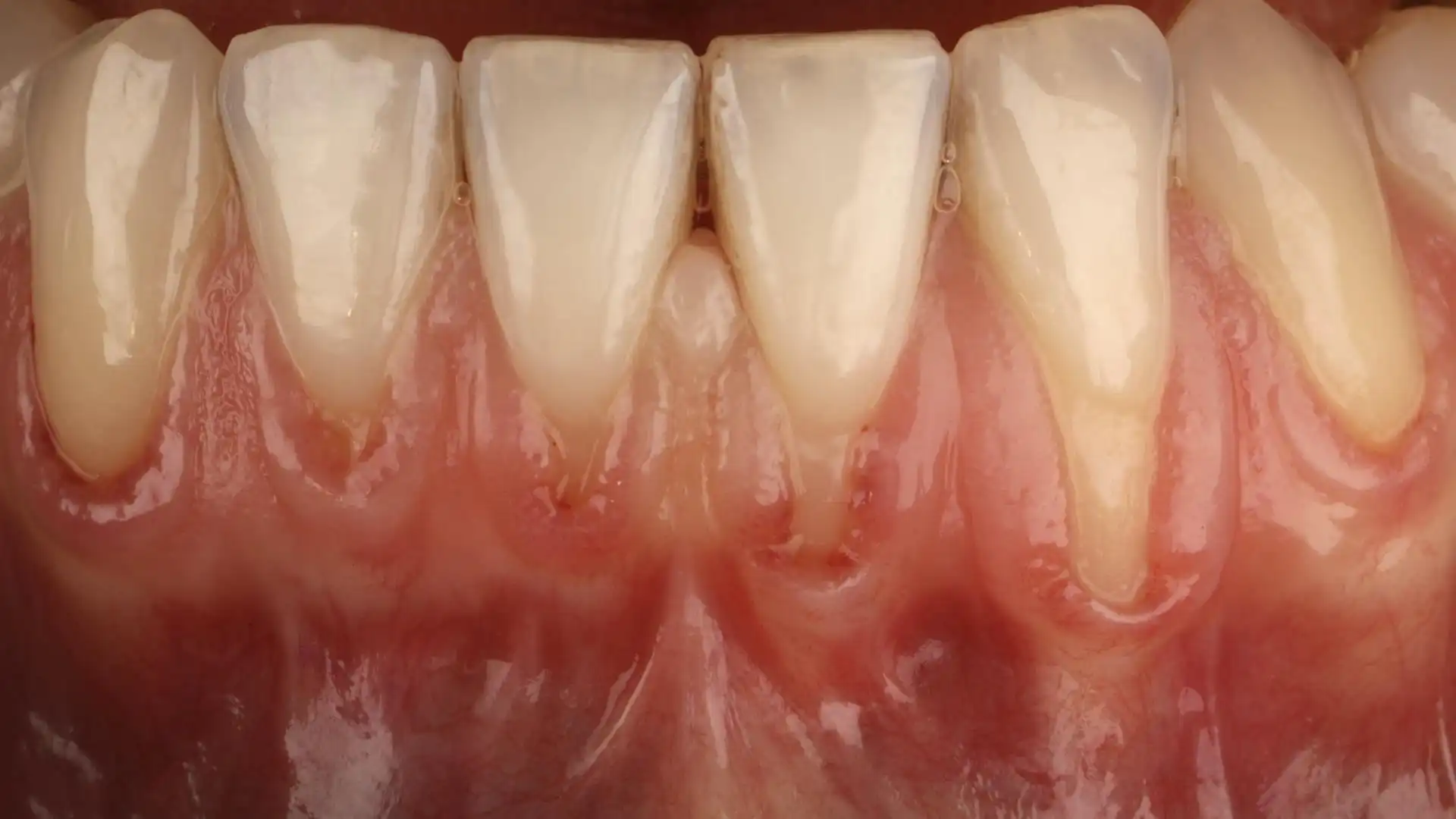 Physiological anatomy and mucogingival deformities of periodontal and ...
