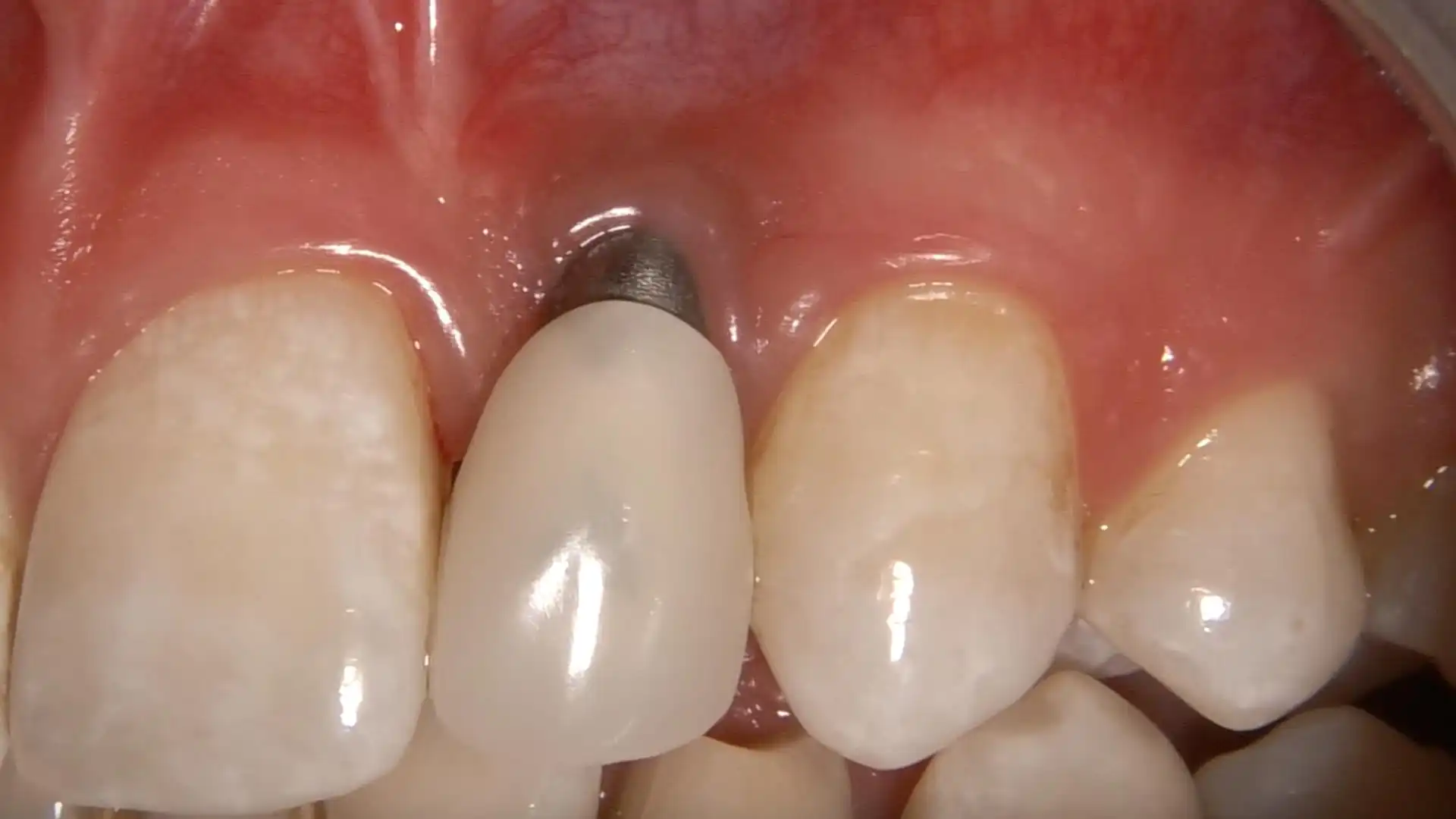 Upper central incisor implant esthetic correction