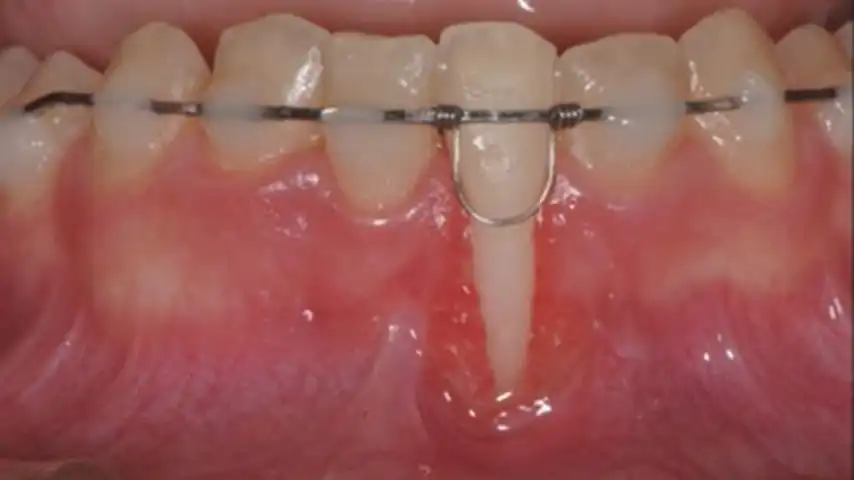 Gingival recession treatment on a lower incisor