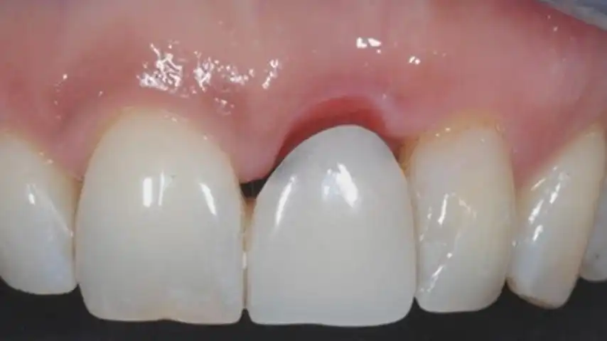 Tooth extraction for periodontal reasons