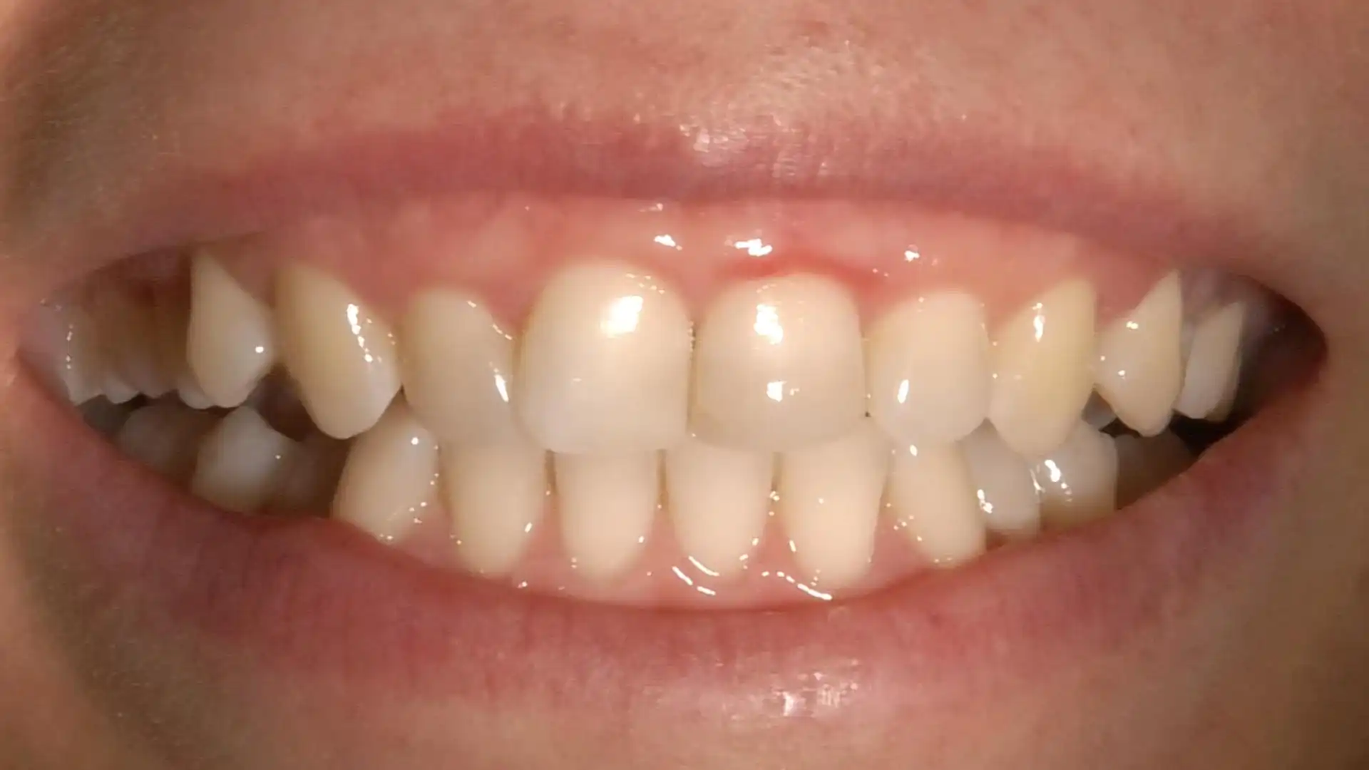 Esthetic treatment of altered passive eruption