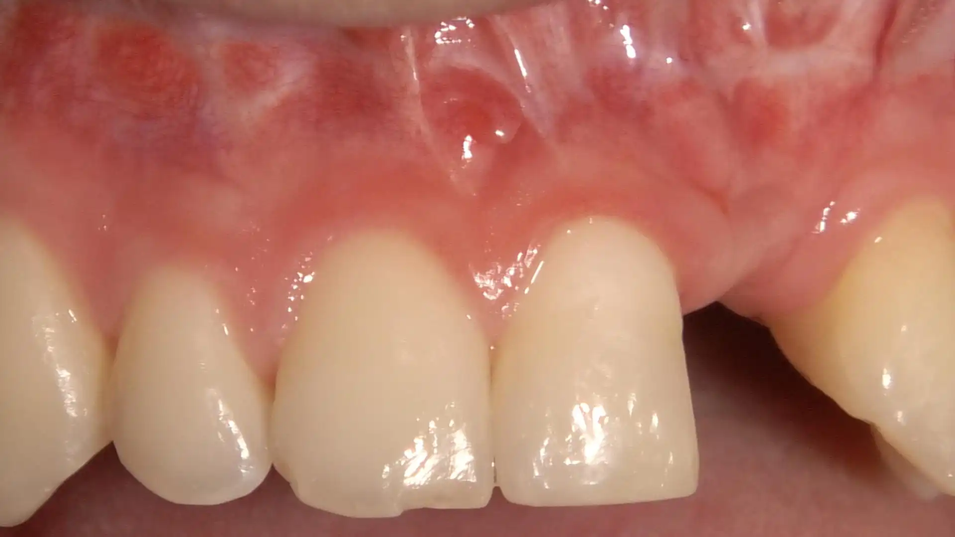 Guided implant on a healed crest with CTG