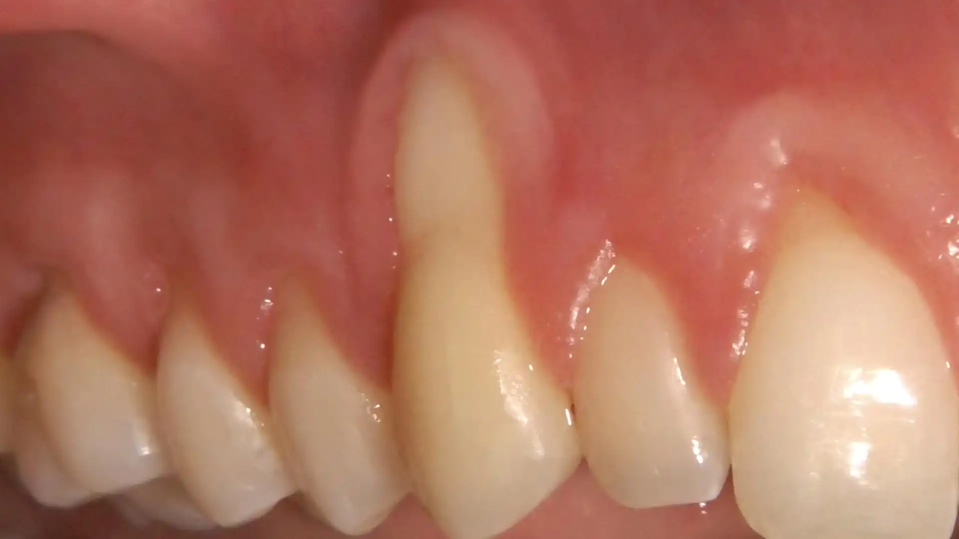 False recession to perform a flap to treat multiple recessions