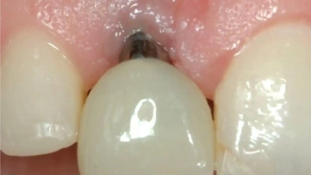 Soft tissue dehiscence coverage around implant-supported crowns: key ...