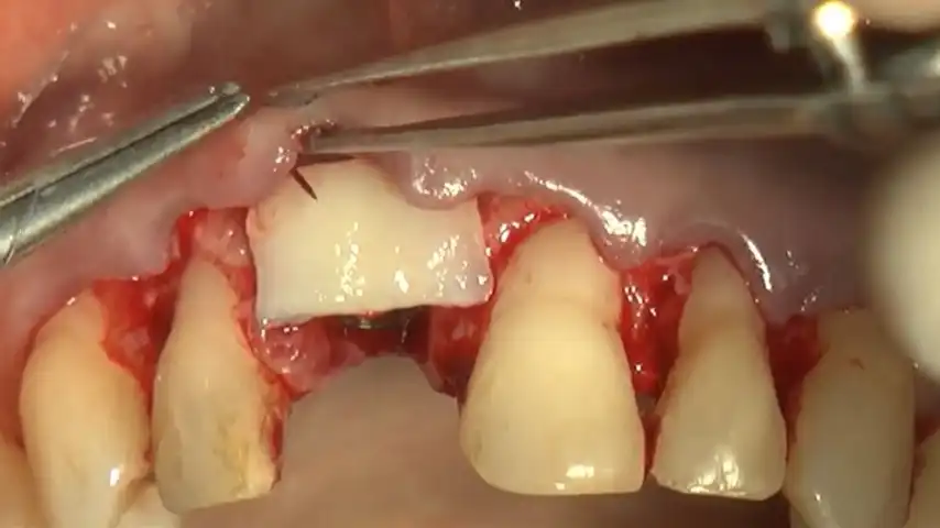 Post-extractive implant placement and immediate loading in aestethic ...