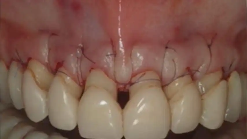 Factors influencing papillae growth