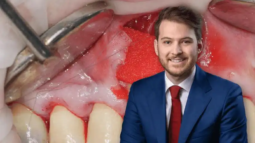 ReLIVE Surgery. Tunneled coronally advanced flap (TCAF) in combination ...