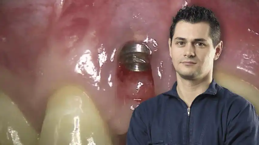 The treatment of peri-implant esthetic defects