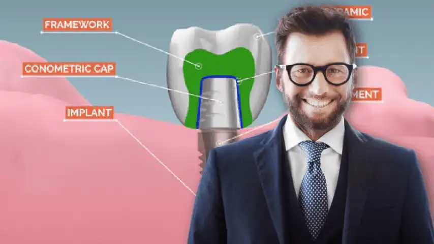 The advantages of fixed conometric prosthetics in implant rehabilitation