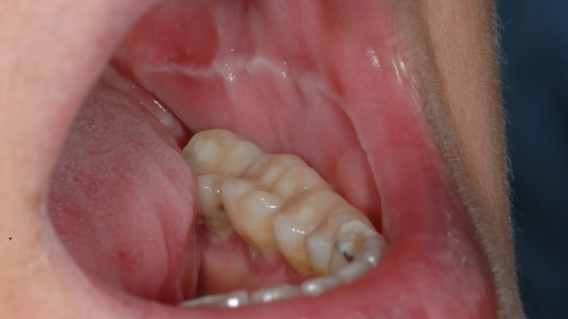 12th Clinical video: Masseter hypertrophy and TMDs