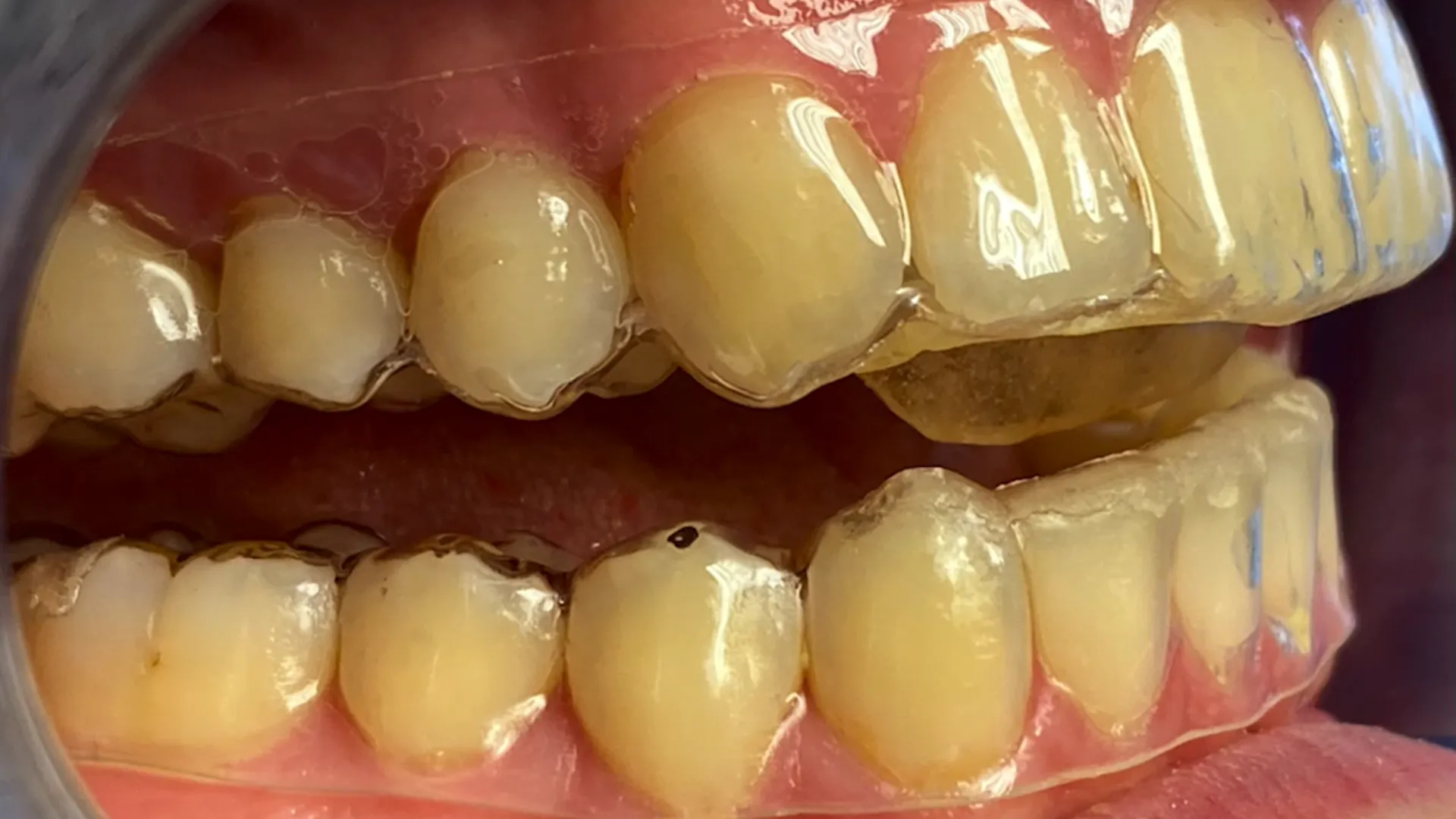 The new definition of bruxism: which are the clinical implications?