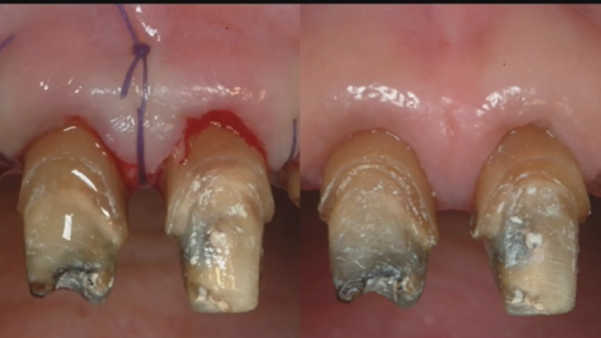 Biological width and supracrestal attachment tissue