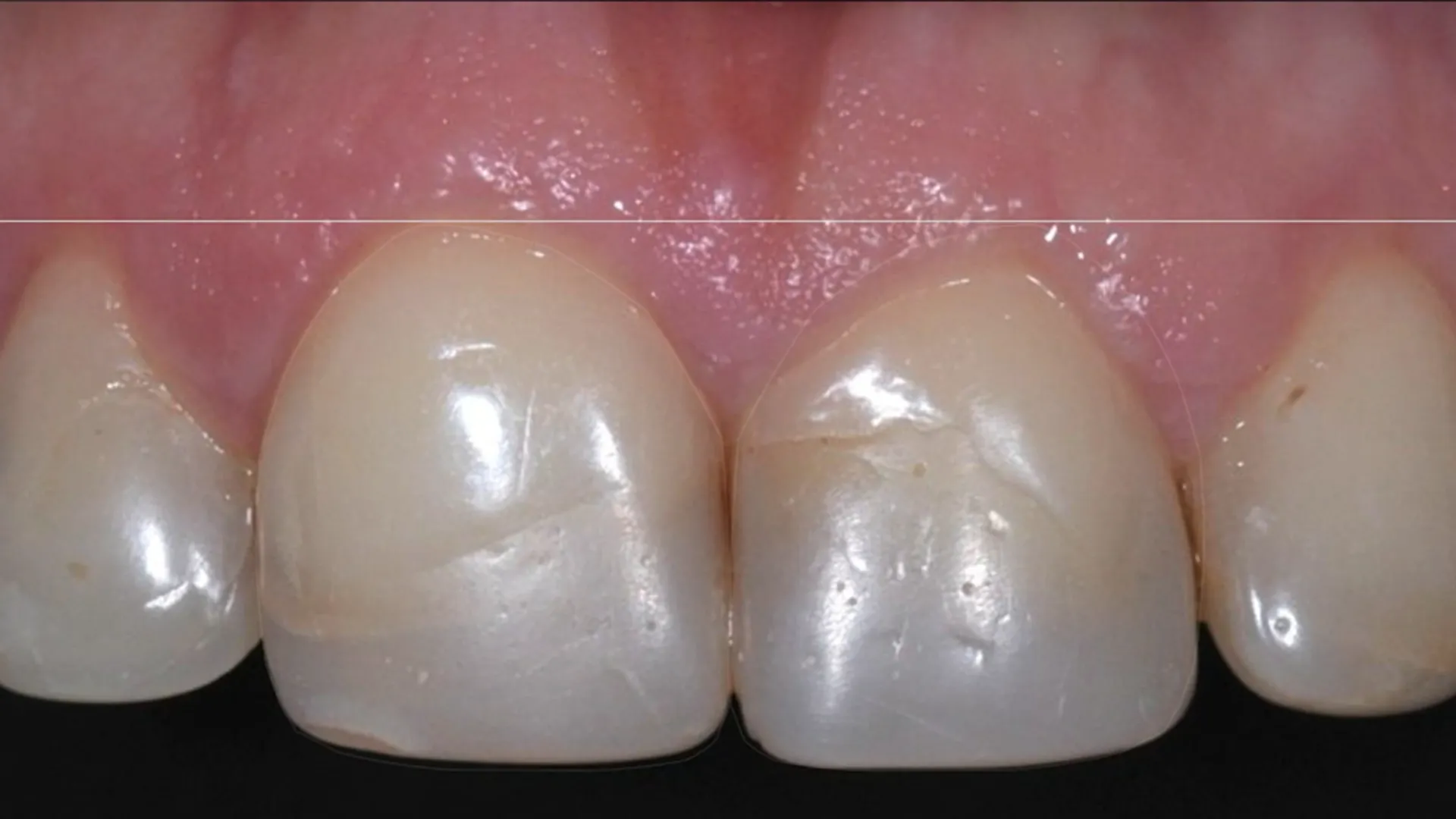 Definitive impression procedure and lab communication: clinical comparison