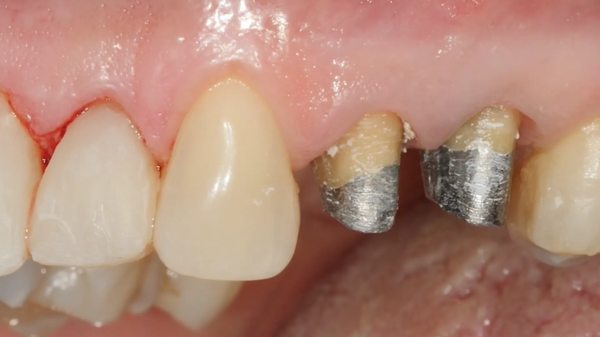 Introduction to horizontal and vertical tooth preparation