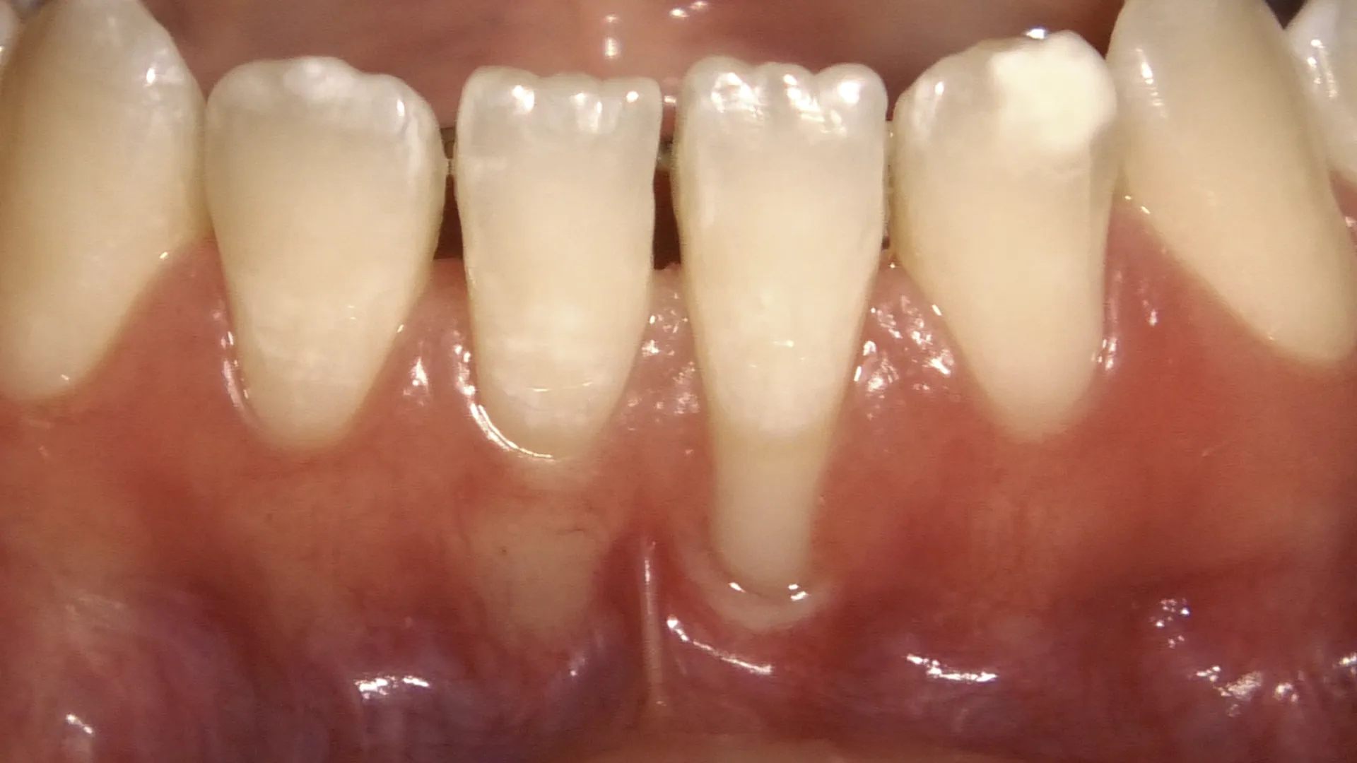Renewals 2024 - Treatment of multiple recessions with a focus on the ...